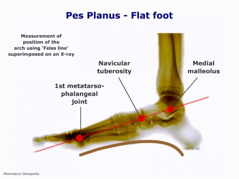 Pes Planus – Flat Foot FOTP04 - Bloomsbury Health Centre