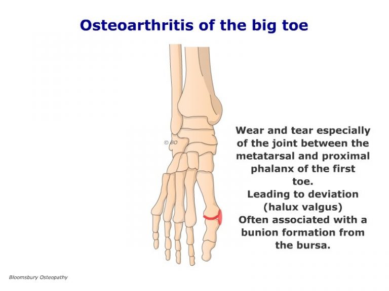 Big Toe Osteoarthritis FOTP08 - Bloomsbury Health Centre