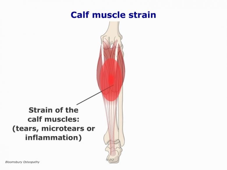 Calf Strain LEGP09 - Bloomsbury Health Centre